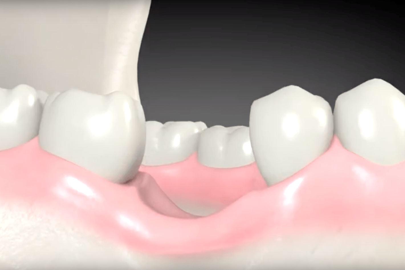 Bone Grafting - Rochester, NY - Periodontal Centers of Rochester