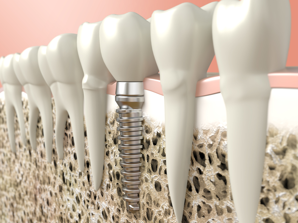 Fear of Dental Implant Failure | Periodontal Centers of Rochester